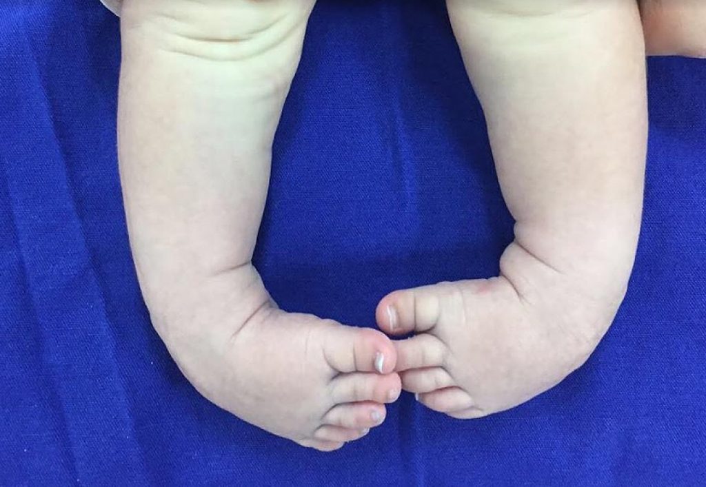 Sindrome Do Pe Torto - RETOEDU